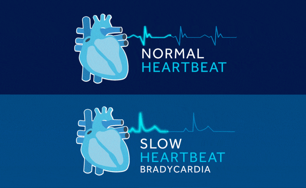 Bradycardia Taking Care Of Your Heart